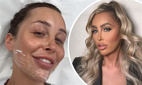 Mafs Uk Star Ella Morgan Reveals Shes Getting Her Filler Dissolved As
