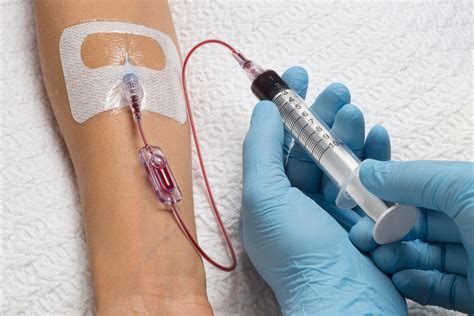 Blood Culture Collection From A Peripheral IV Catheter With A Syringe Kurin