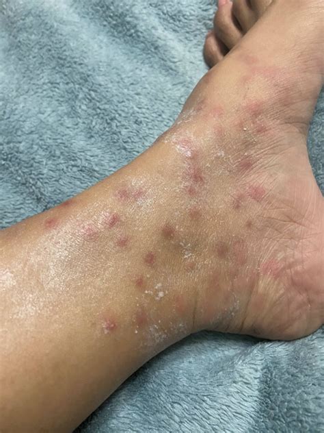 Sand Fleas Bites In Puerto Rico Work Travel And Take Photos