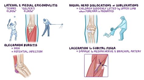 Medial Epicondylitis