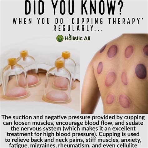 21 Cupping Therapy Chart Ideas In 2025 Cupping Therapy Cupping