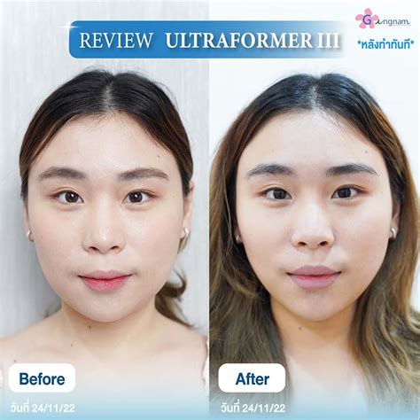 Ultraformer Iii คืออะไร ช่วยเรื่องอะไรบ้าง ทำแล้วเห็นผลจริงไหม