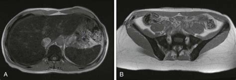 Diffuse Liver Disease Radiology Key