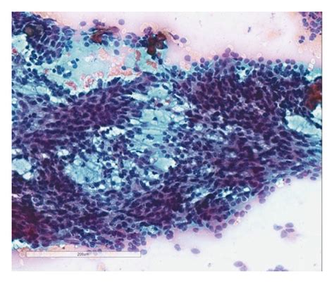 A Conventional Smear Showing Basaloid Cells In Sheets With Focal