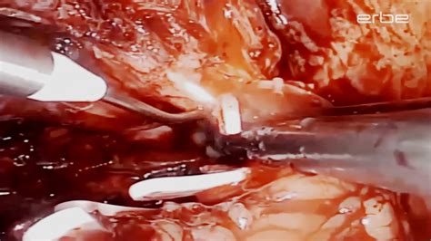 Nerve Sparing Laparoscopic Radical Prostatectomy With Hydrodissection Intrafascial Technique