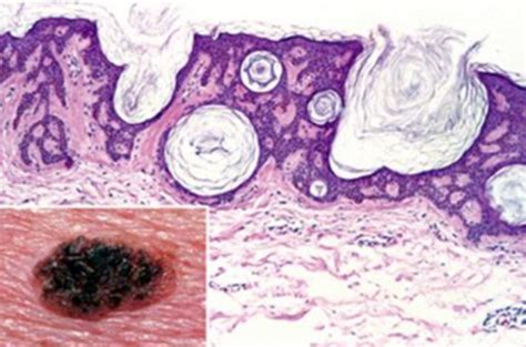 36 Tumors Of The Epidermis Flashcards Quizlet