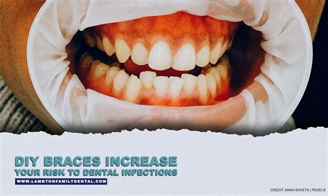 The Dangers Of DIY Braces Lambton Family Dental