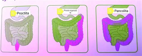 Rectocolita Ulcero Remoragica Cufurtunuldupatine On Tumblr