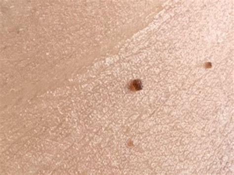 気になる首イボ 自宅で簡単綺麗に取ることに成功。その方法とは？ 無駄遣い備忘録
