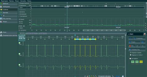 Holter Ecg