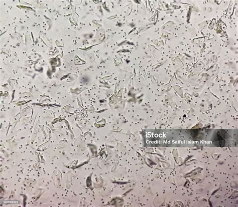 고름 세포와 Rbc로 히알린 캐스트를 보여주는 현미경 소변 검사 소변에 대한 스톡 사진 및 기타 이미지 소변 배율 과학 실험 Istock