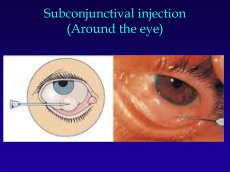 Research Better Delivery Of Drugs And Devices For Glaucoma Ppt Download