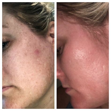 Cosmelan Peel Before And After Results With Photos At Pfam Prfct