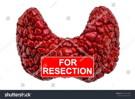 Thyroid Resection Hanging Sign 3d Rendering Stock Illustration 1981664903 Shutterstock