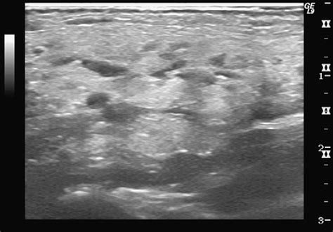 Longitudinal Sonogram Of Parotid Gland Lightly Hyperechogenic