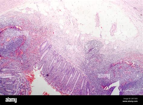 Histopathology Of Chronic Appendicitis Light Micrograph Photo Under