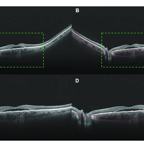 b scans indicating the segmentation of the choroid in an eye with csc