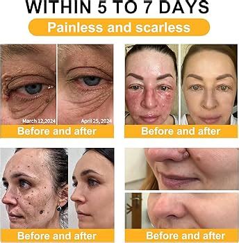 Bee Venom Cream Reviews Before And After Insights Australian