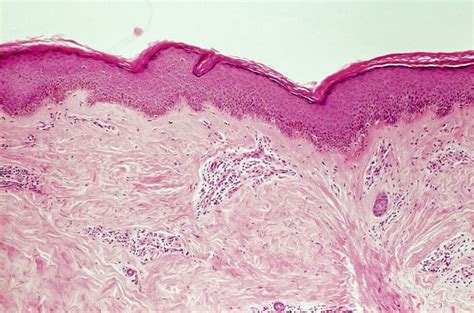 Systemic Sclerosis Pathophysiology Rare Disease Advisor