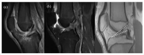 Primary Findings That Suggest An ACL Injury Are Abnormal Signal Download Scientific Diagram