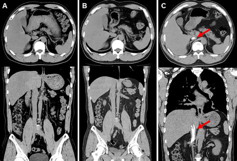 Figure5computed Tomography Findings Of Calcification In The Inferior