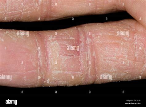 Close Up Of Cracked And Scaly Skin On The Fingers Of The Hand Of A 41