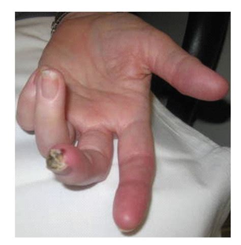 Digital Ischemia In Scleroderma Spectrum Of Diseases Pmc