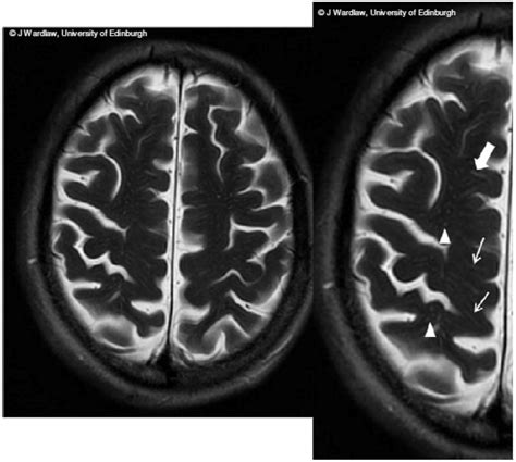 Automated Methods For Detecting And Quantitation Of Enlarged