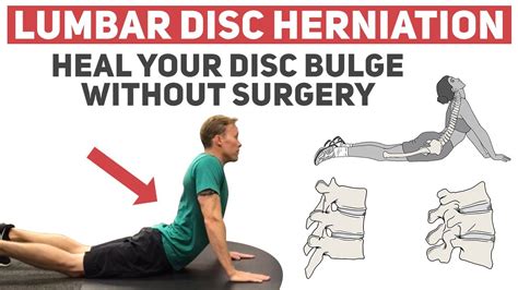 Lumbar Spine Herniated Disc Exercises At Robt Shannon Blog