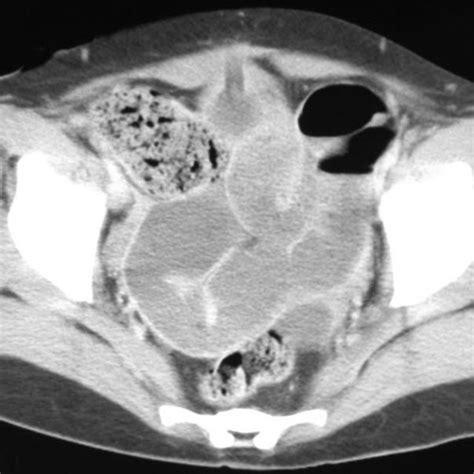 Microscopic Pathology Revealed Extensive Mucosal Necrosis Consistent
