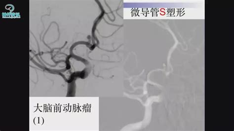 何旭英教授：颅内动脉瘤栓塞术中微导管塑形的体会 脑医汇