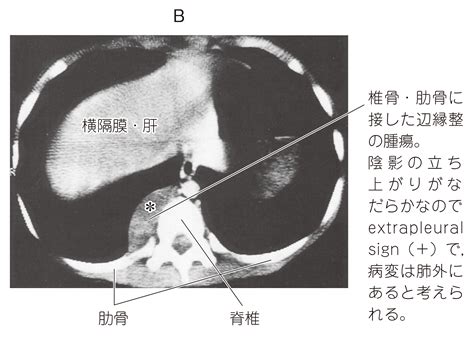 84d24 縦隔腫瘍 国試 M3e Medical