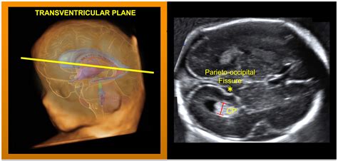 Fetal Hydrocephalus Ultrasound