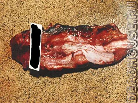 【超！閲覧注意】伝説の画像。感電死史上1番ヤバイ、高圧電流を流され続けた人間の姿 ポッカキットポッカキット