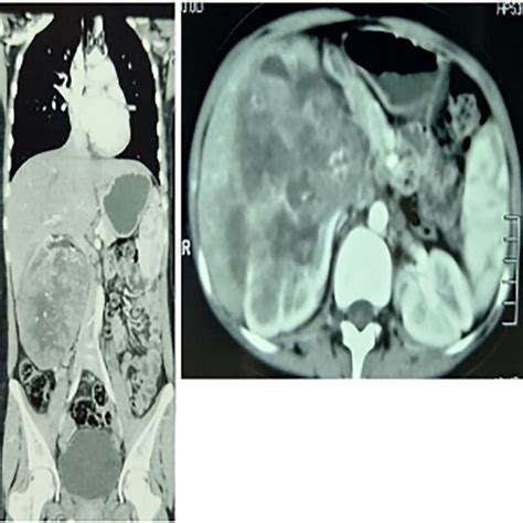 To The Left Coronal Section Multiple Slice Computed Tomography Slice