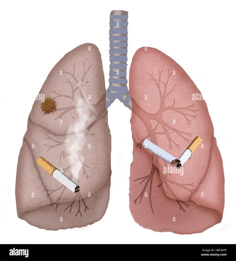 Pulmones Fumadores Sanos Fotos E Imágenes De Stock Alamy