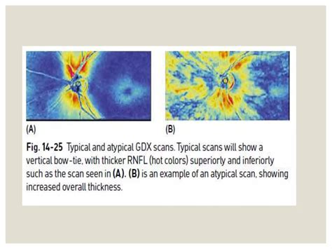 Imaging In Glaucoma Pptx Eye And Vision Conditions Diseases And Conditions