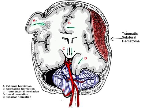 Figure Brain Herniation Image Courtesy S Bhimji MD StatPearls
