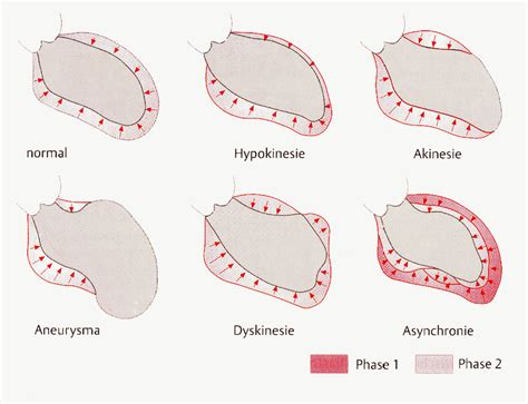 The Classification Of Wall Motion Abnormalities Based On Their