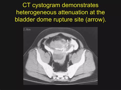 Imaging Abdomen Trauma Urinary Bladder Trauma Part 8 Dr Ahmed Esawy