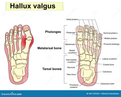 Hallux Valgus Anatomie Menselijke Voetbeenderen Handtekeningen Ook