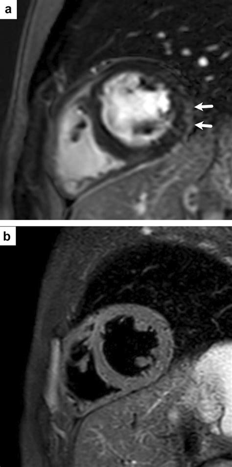 Cardiac MR Images Obtained Four Months Later Revealed That The Findings