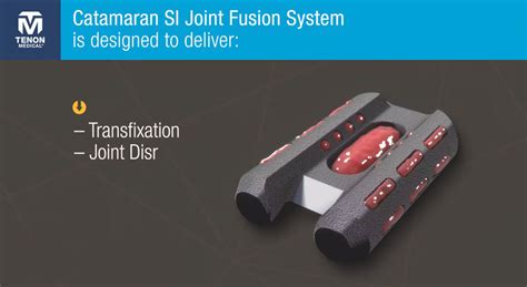 Catamaran Si Joint Fusion Device Overview Tenon Medical Video