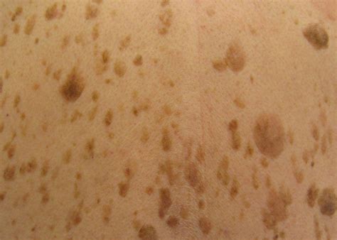 Preventing And Treating Benign Barnacles Seborrheic Keratoses On The
