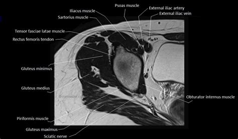 MRI Anatomy Of Hip Joint Free MRI Axial Hip Anatomy