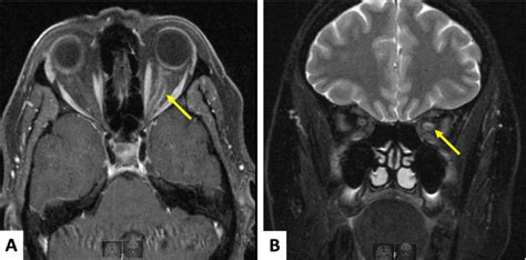 A Axial Fat Saturated Postcontrast T1 Weighted Mri Shows Homogeneous