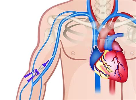 Sydney Interventional Radiology Picc Line Insertion Sydney Interventional Radiology
