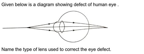 What Are The Type Of Eye Defects