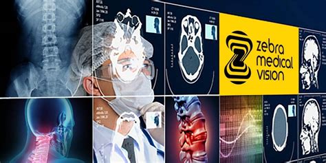 AMA Issues Category III CPT Code For VCF Detection From CT Scans For
