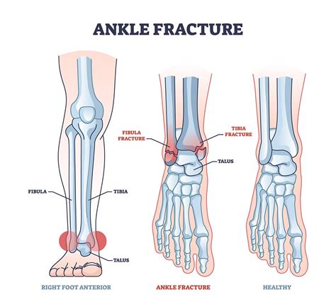 Ankle Fractures Orthopedic Institute